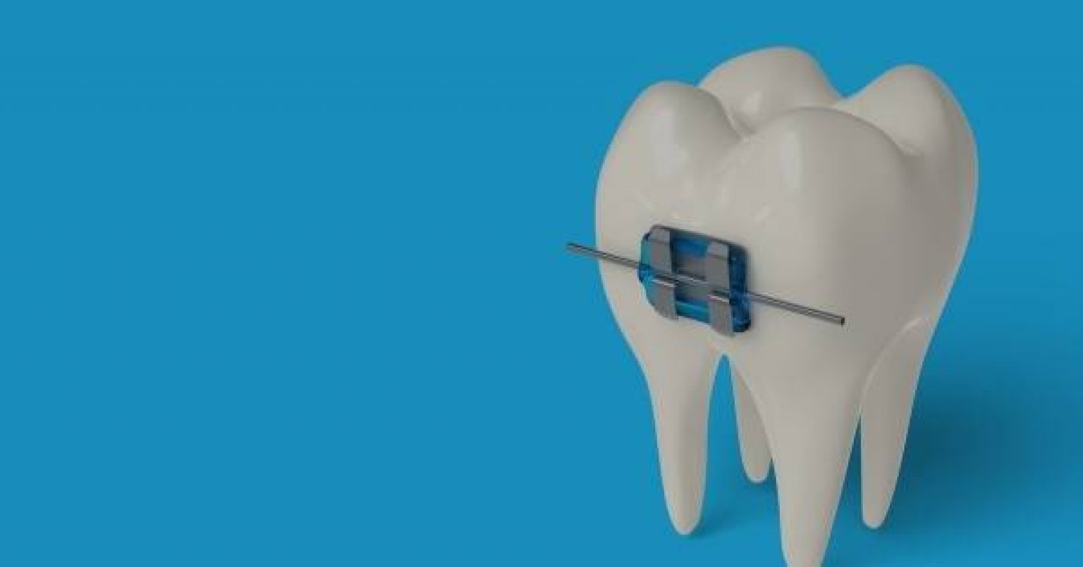Can You Put Diamonds On Braces? Ultimate How To Guide [year]
