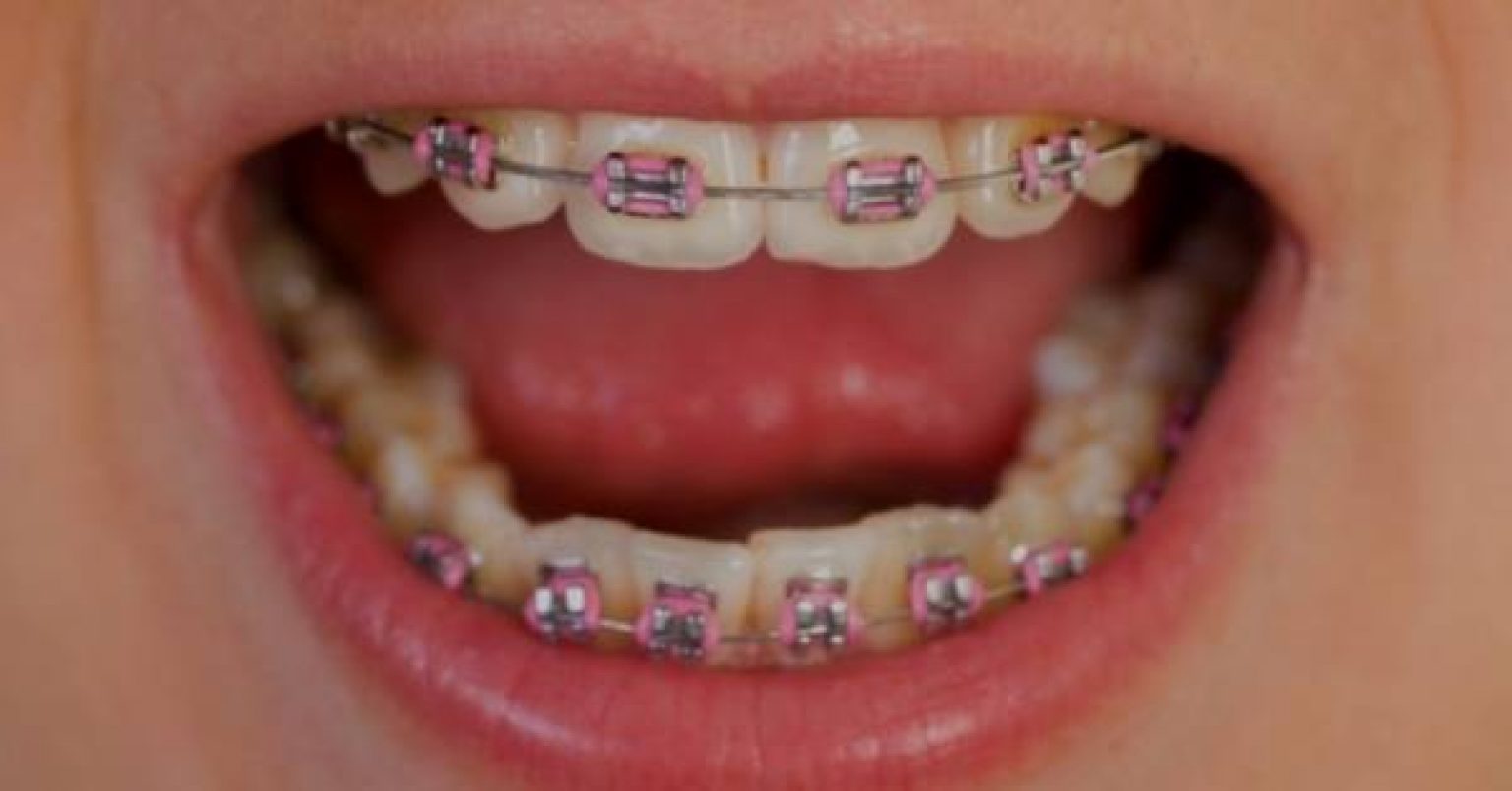 Hot Pink Braces: 10 Pros & 3 Cons! Ultimate [year] Guide!