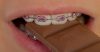 Hot Pink Braces: 10 Pros & 3 Cons! Ultimate [year] Guide!