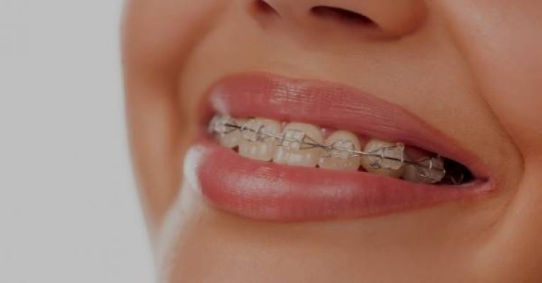 Diamond Braces Vs Basic Braces [Ultimate [year] Guide]