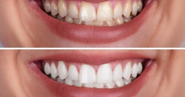 Are Yellow Teeth Healthy? Prevention & Treatment | Guide [year]