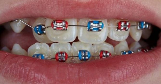 19 Reasons To Choose Blue Braces Color | Ultimate [year] Guide