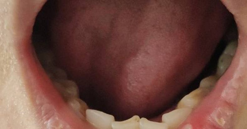 How To Take Lysine For Canker Sores! Get Better Overnight!