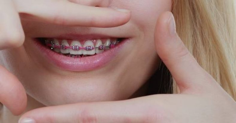 20 Cute Braces Colors & Color Combinations | Stylish In [year]