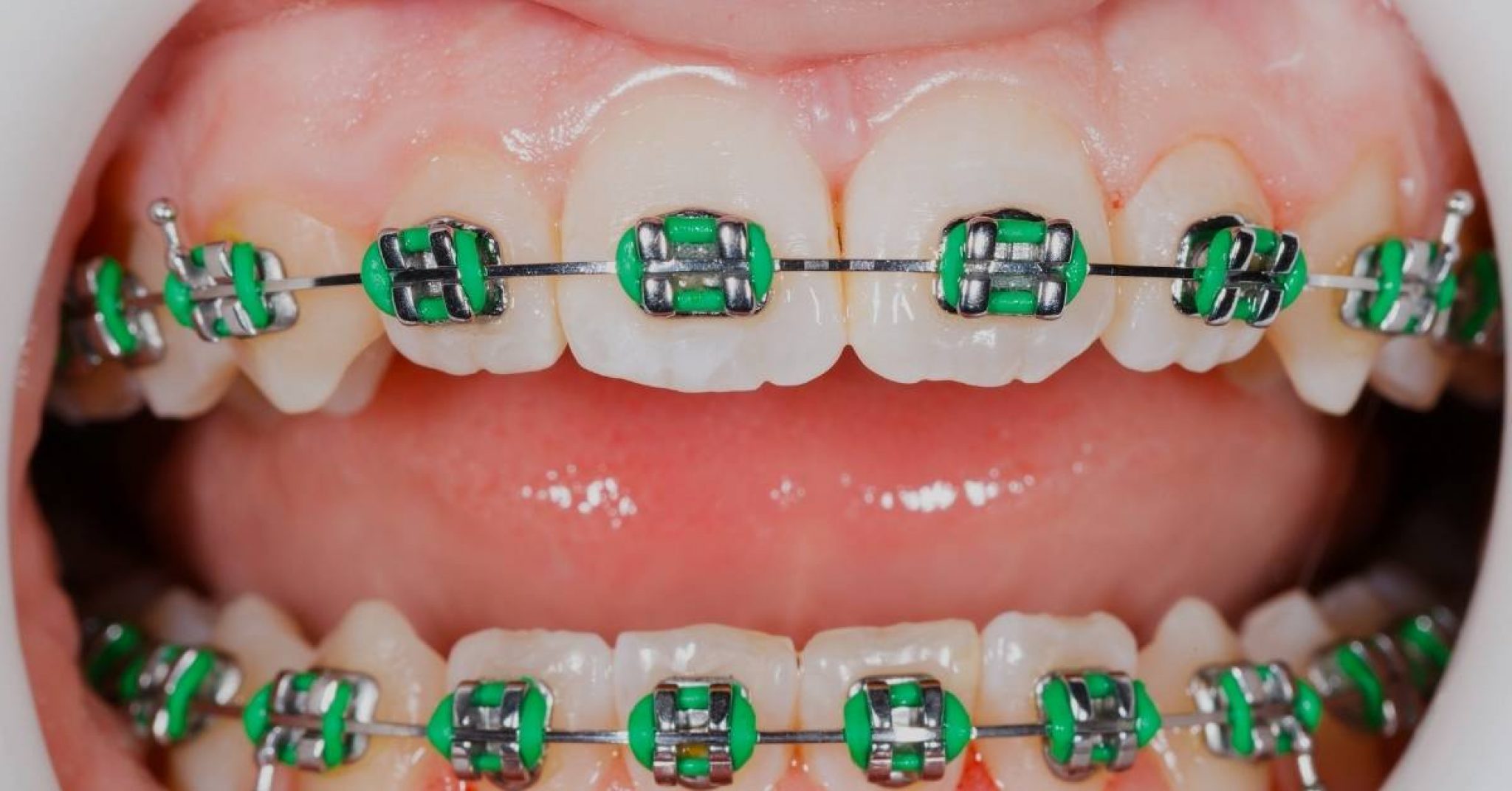 20 Cute Braces Colors & Color Combinations | Stylish In [year]