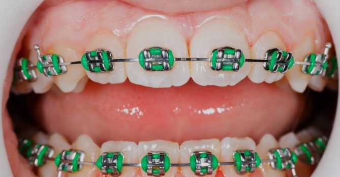 20 Cute Braces Colors & Color Combinations | Stylish In [year]