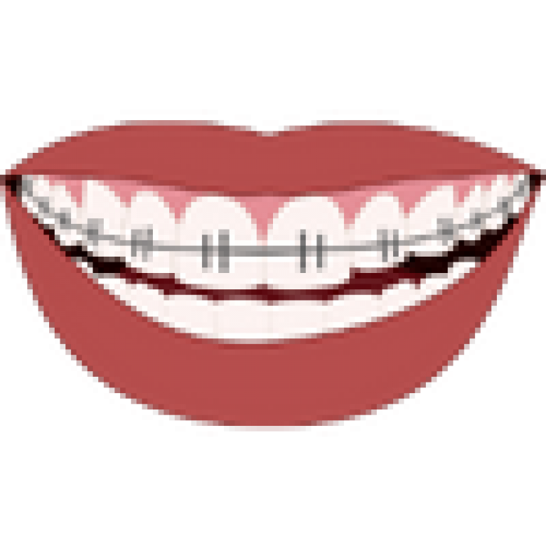 20 Reasons To Choose Black Braces Color | Ultimate [year] Guide