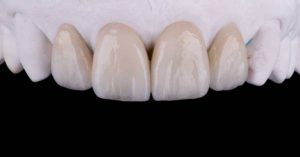5 Ways To Fix Overlapped Front Teeth Easily | Best Guide [year]