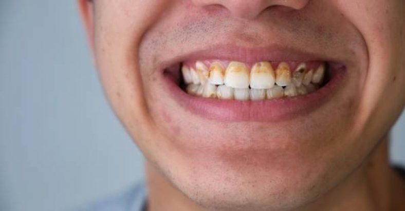 10 Natural Ways To Remove Tartar From Teeth Without Dentist!