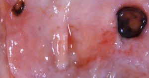 Canker Sores On Tonsil: How To Heal Ulcer On Tonsil Quickly!