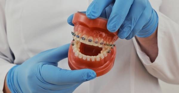 20 Cute Braces Colors & Color Combinations | Stylish In [year]