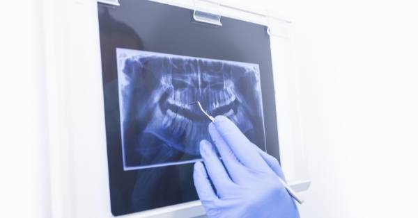 What Are Dental Spacers For Teeth? Ultimate [year] Guide
