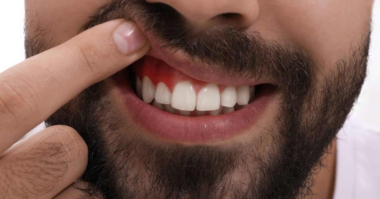 Does Gum Disease Go Away When Teeth Are Removed? [year] Guide