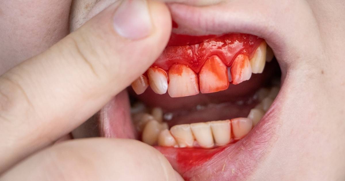 5 Stages Of Gum Disease With Symptoms & Possible Treatments!