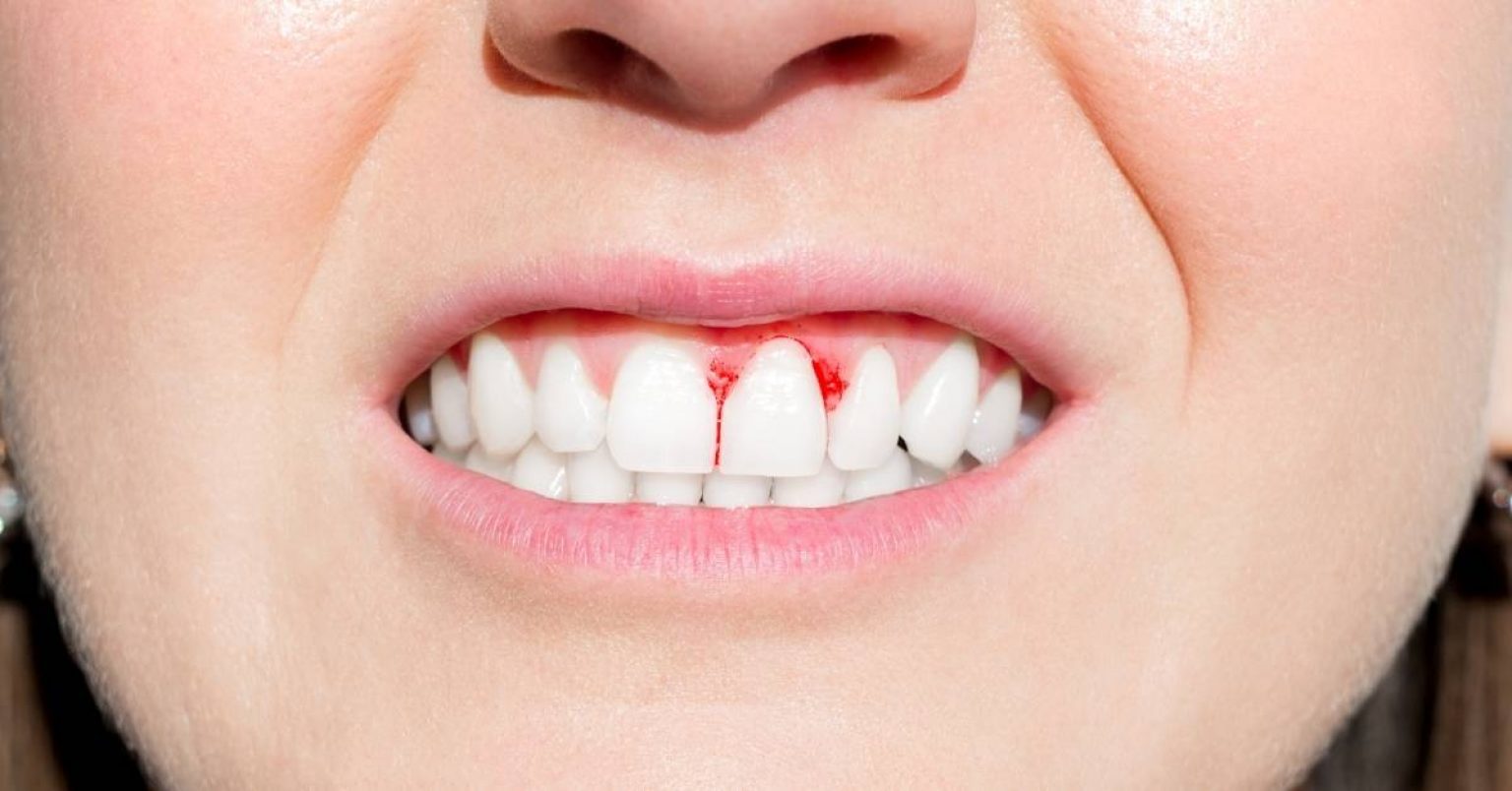 Does Gum Disease Go Away When Teeth Are Removed? [year] Guide