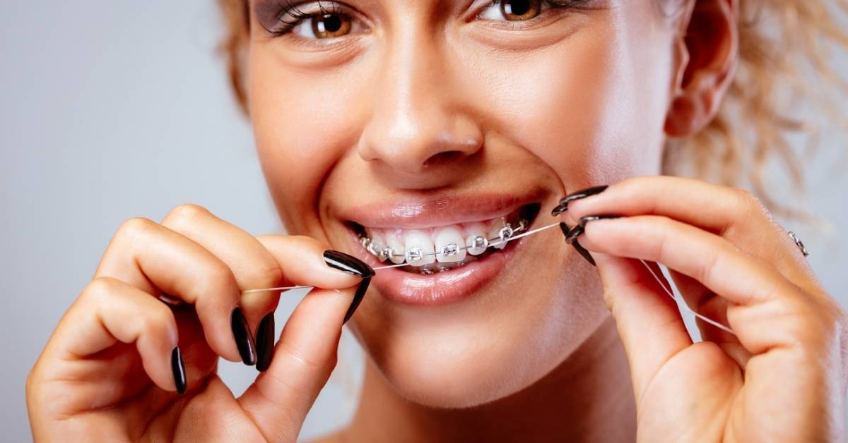 Most Popular Braces Color For Girls! Best Buying Guide [year]