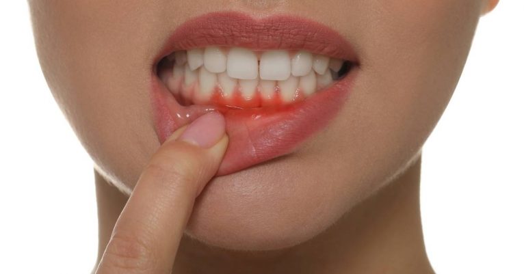 Do Your Gums Hurt When Chewing? Here Is Why & How To Treat It