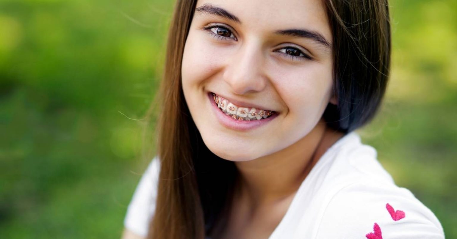 Most Popular Braces Color For Girls! Best Buying Guide [year]