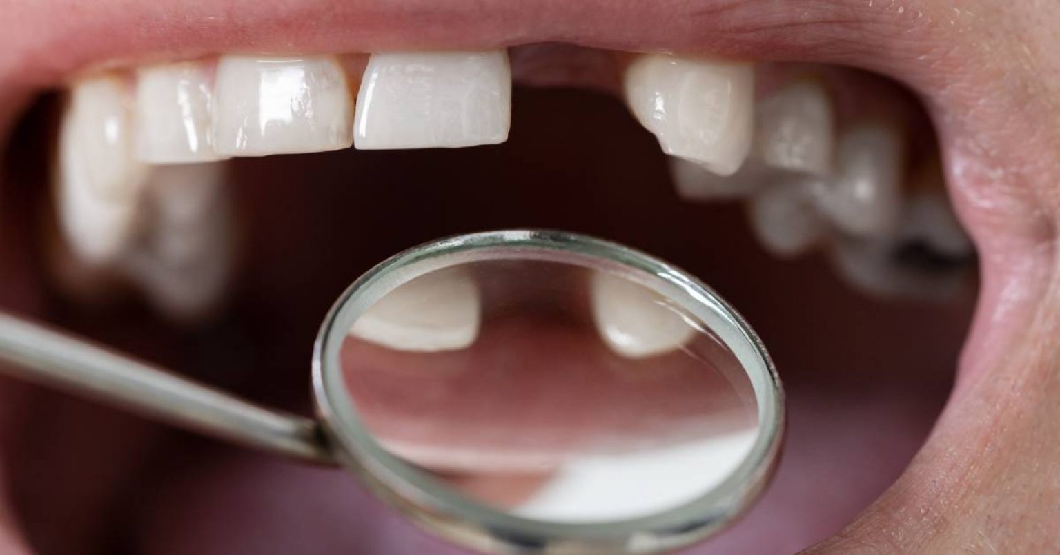 7 Main Causes Why Your Teeth Are Falling Out & Treatment!