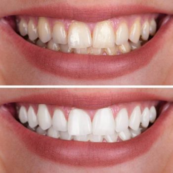 What Do Healthy Teeth Look Like: 10 Signs Of Good Teeth!