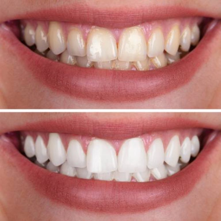What Do Healthy Teeth Look Like: 10 Signs Of Good Teeth!