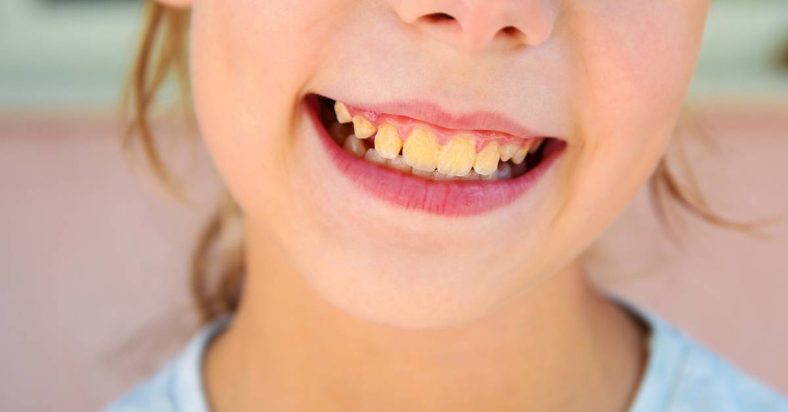 Why Do Redheads Have Yellow Teeth? Decoding The Mystery! [year]