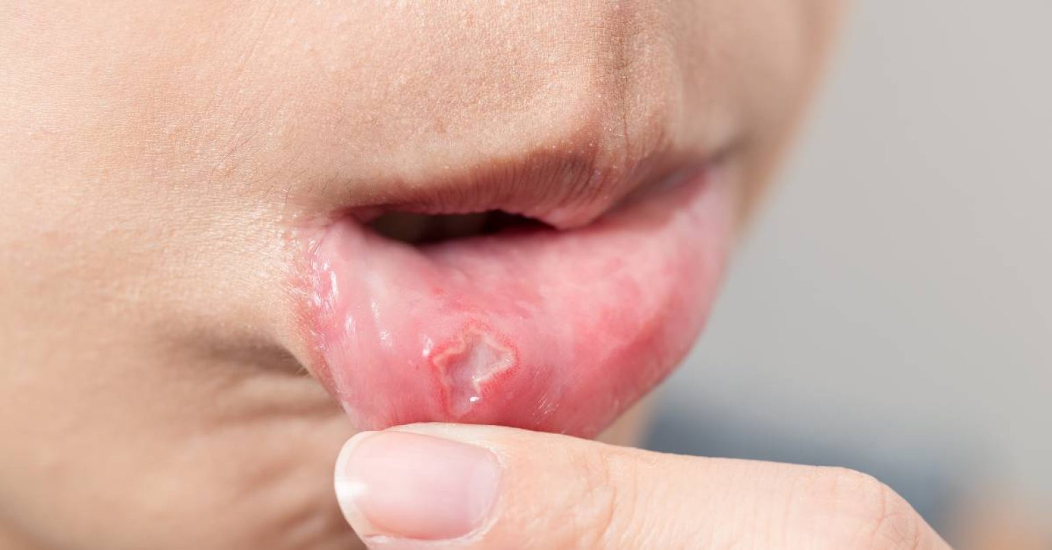 What Does A Canker Sore Look Like? Identifying And Treatment Options