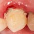 5 Ways To Fix Overlapped Front Teeth Easily | Best Guide 2023